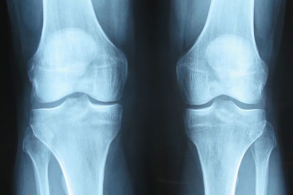 Condromalacia Rotuliana: Qué es, causas, síntomas y tratamiento ...