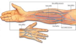 Flebitis: Qué es, tipos, síntomas y cómo evitar - Demedicina.com